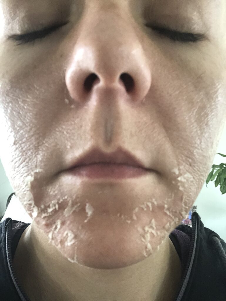 What is a TCA peel? 7 Amazing Days Of Powerful Photos