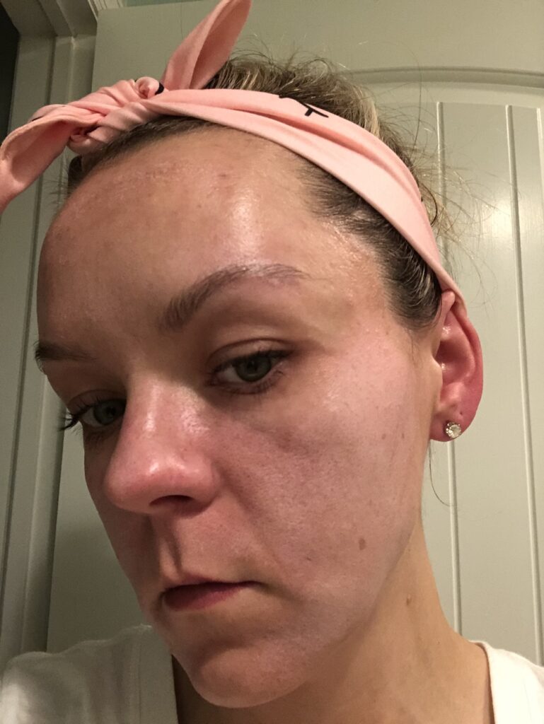 What is a TCA peel? 7 Amazing Days Of Powerful Photos