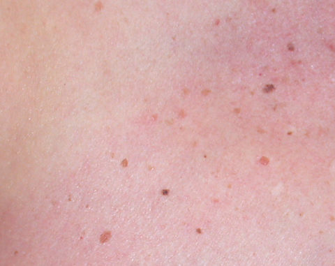 Morag Currin offers Tips To Treating Radiation Dermatitis