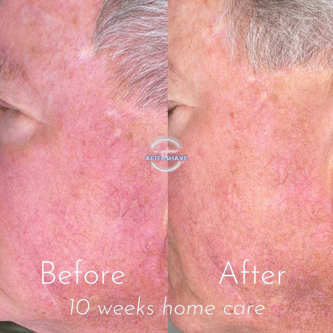 Healing Compromised Skin After Topical Chemotherapy