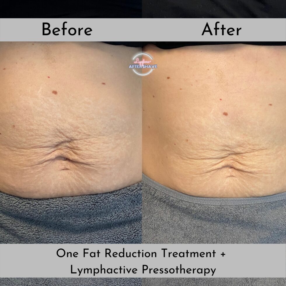 Pro Review of STAR T-SHOCK's 2 Areas Face + Tummy Results