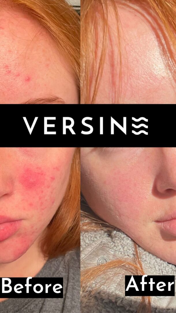 Versine Skincare Reviews Safe For Pregnancy Great For All