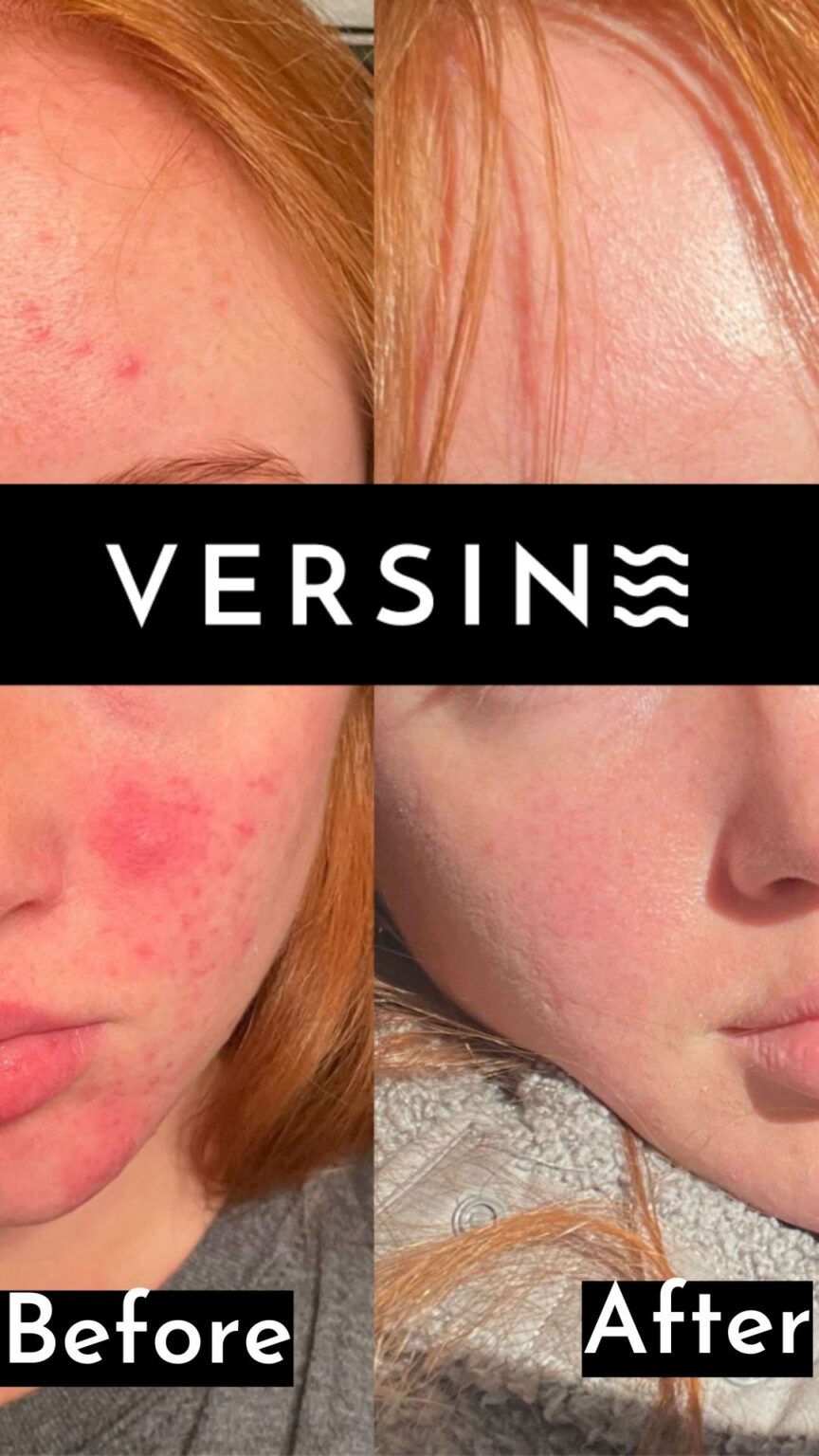Versine Skincare Reviews Safe For Pregnancy Great For All