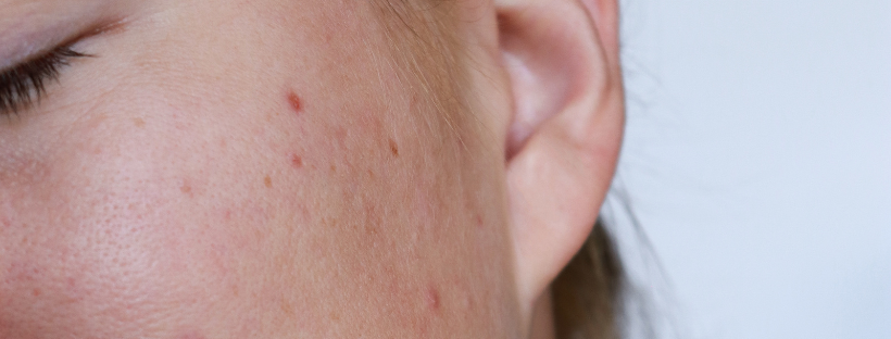 Scar Management & Revision: Healing Skin, Restoring Function ...